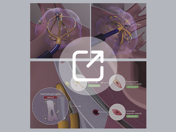 PFA Clinical Publications - Boston Scientific - Boston Scientific